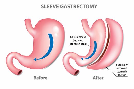 Sleeve Gastrectomy Weight Loss Surgery in Indore | Bariatric Surgery